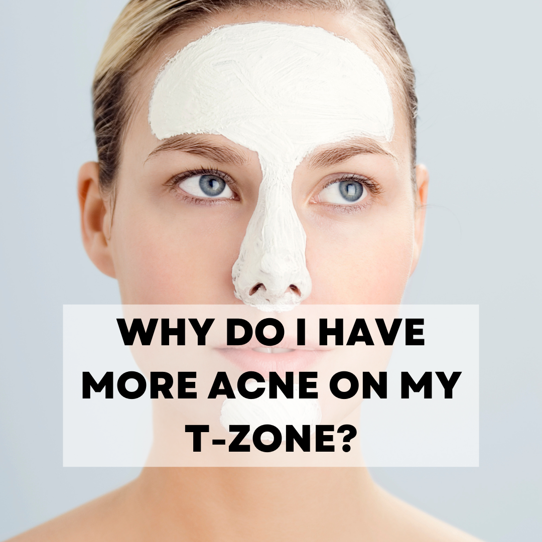 Why do I have more acne on my T-Zone? – Eden Body Care
